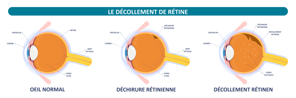 Pathologies rétiniennes - OphtaMaine - Le Mans 72
